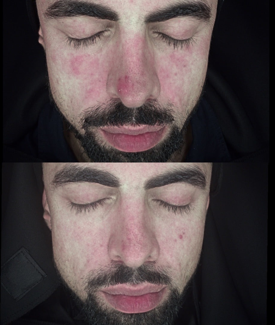 Lets discuss breakouts – Harmony Skin